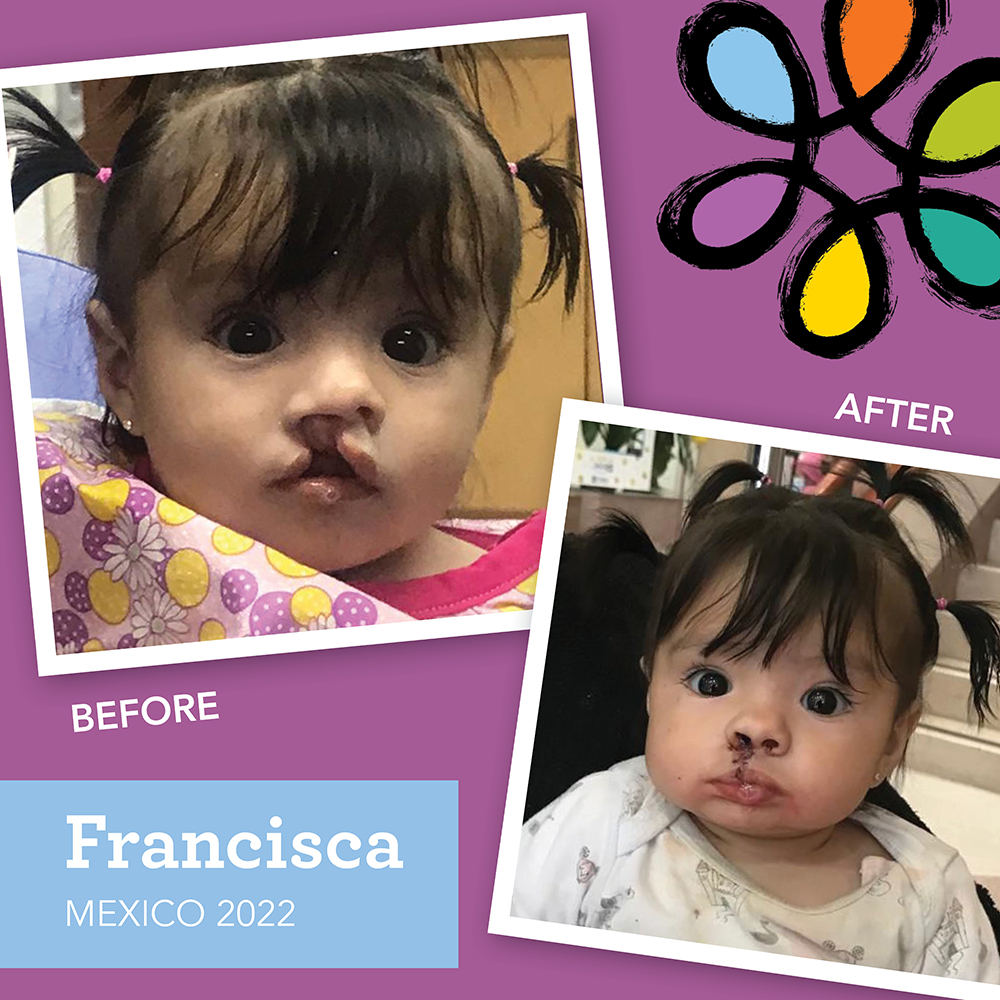 Children's Surgery International | Transformations in Mexico